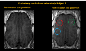 Cordance Demonstrates Multi-Site Blood-Brain Barrier Openings in Pre ...